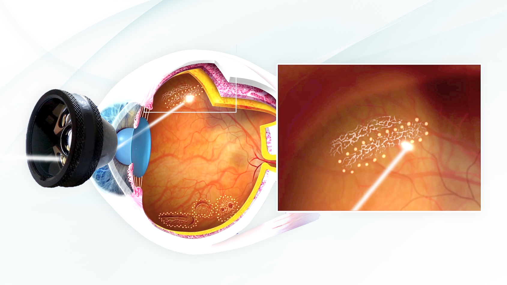 Peripheral retinal degeneration - Diagnosis - Video